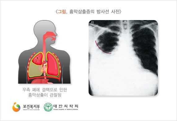 폐에 물이 차면 네이버 블로그
